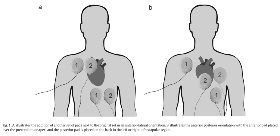 Dual Sequential Defibrillation (DSD) - REBEL EM - Emergency Medicine Blog