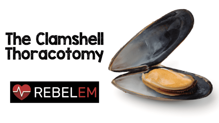Clamshell Thoracotomy - REBEL EM - Emergency Medicine Blog