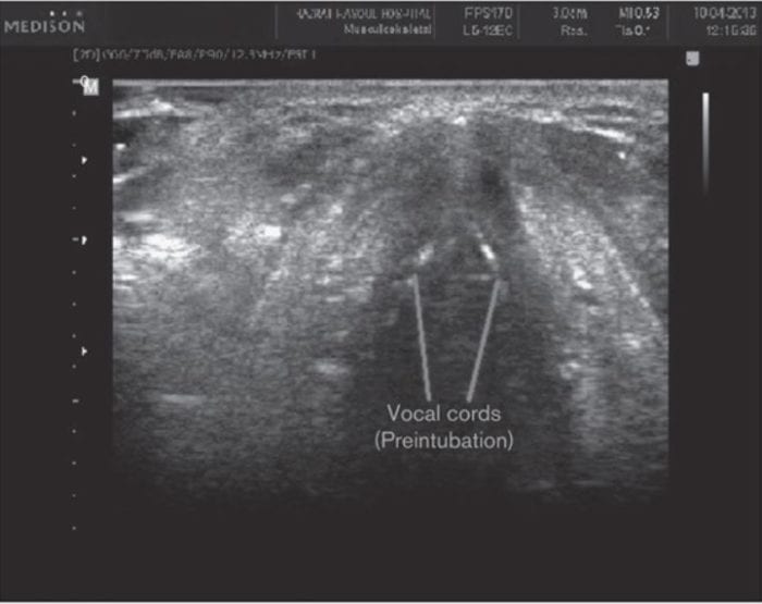 POCUS for Endotracheal Tube Confirmation - REBEL EM - Emergency ...