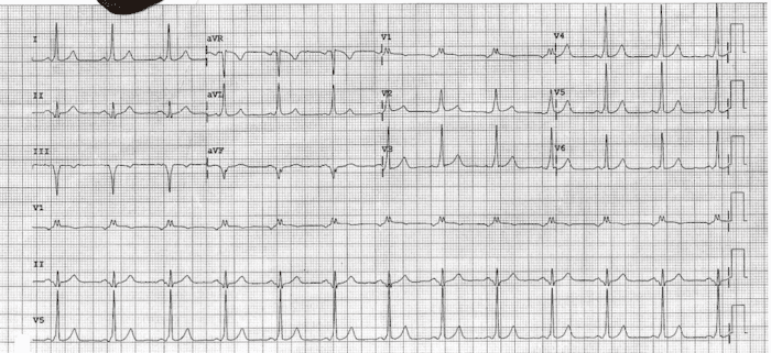REBEL Core Cast 21.0 - ECG in Syncope - REBEL EM - Emergency Medicine Blog