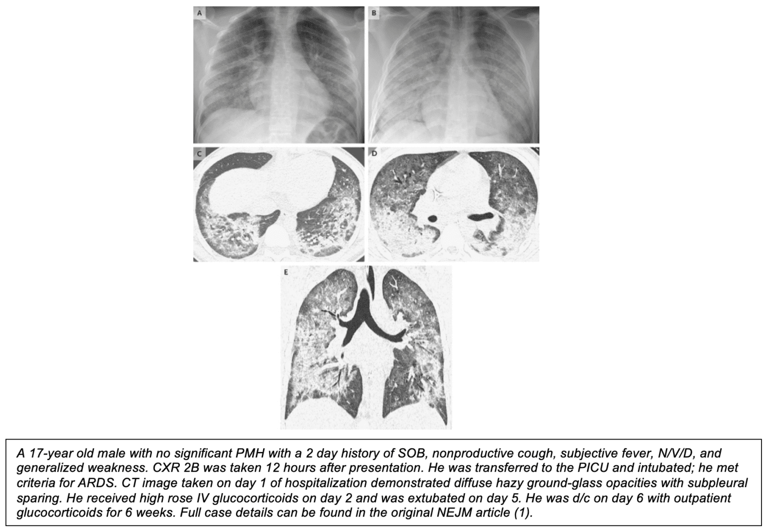 Vaping Associated Lung Injury (VALI) - REBEL EM - Emergency Medicine Blog Vaping Associated Lung Injury (VALI) - REBEL EM - Emergency Medicine Blog
