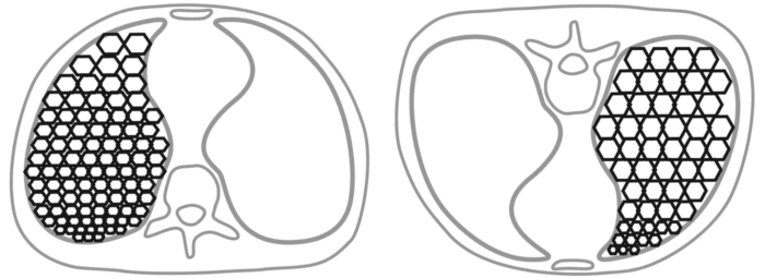 COVID-19 Hypoxemia: A Better and Still Safe Way - REBEL EM - Emergency ...