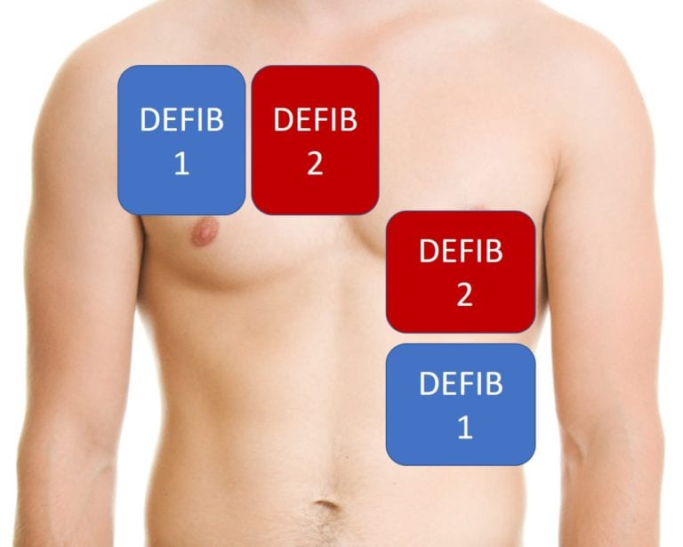 The Dose Vf Pilot Rct Double Sequential External Defibrillation For Refractory Ventricular