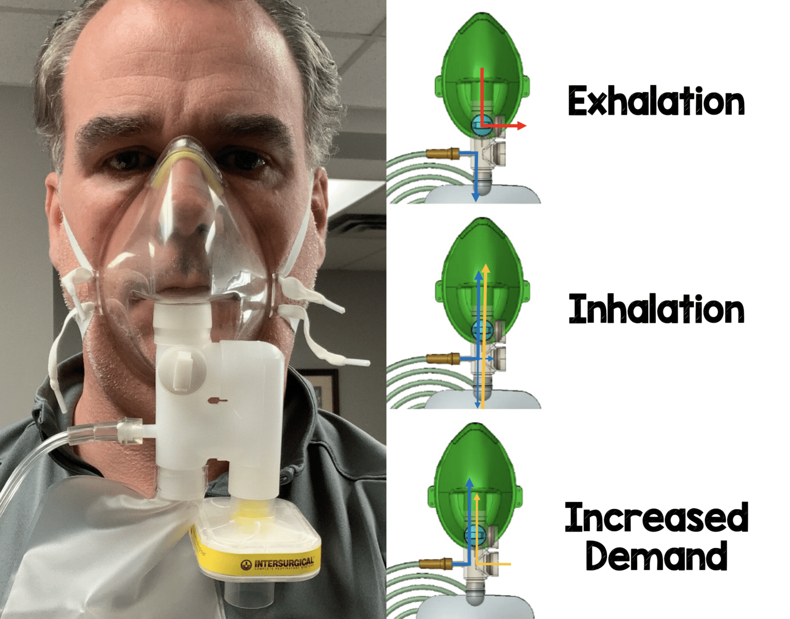 COVID-19: Airway Management - REBEL EM - Emergency Medicine Blog