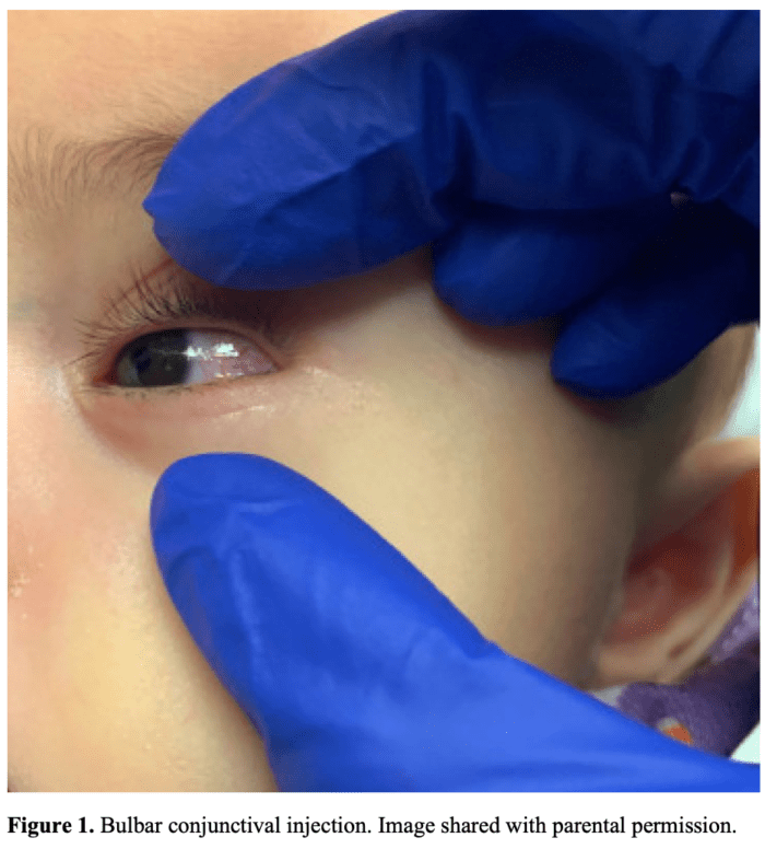 KD Conjunctival Injection - REBEL EM - Emergency Medicine Blog