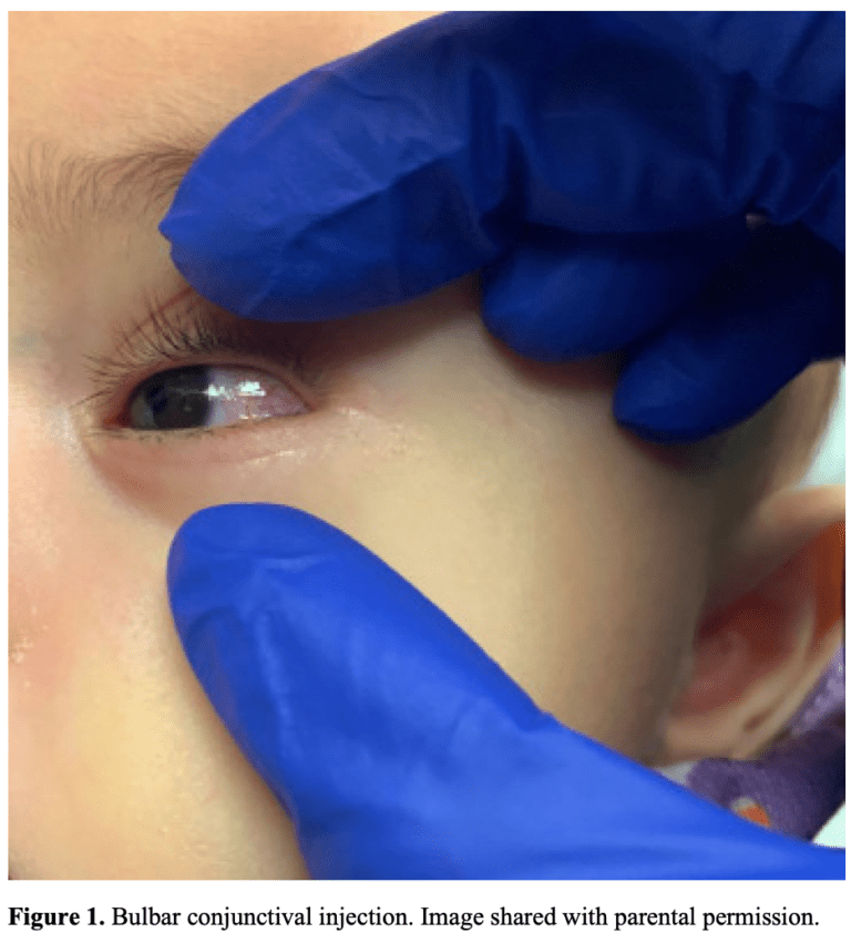 KD Conjunctival Injection - REBEL EM - Emergency Medicine Blog