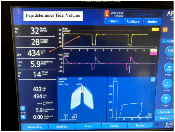 REBEL Crit Cast Ep3.0: Airway Pressure Release Ventilation (APRV) Made ...