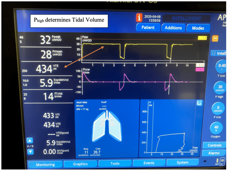 REBEL Crit Cast Ep3.0: Airway Pressure Release Ventilation (APRV) Made ...