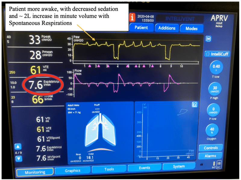 APRV Spontaneous Respirations - REBEL EM - Emergency Medicine Blog