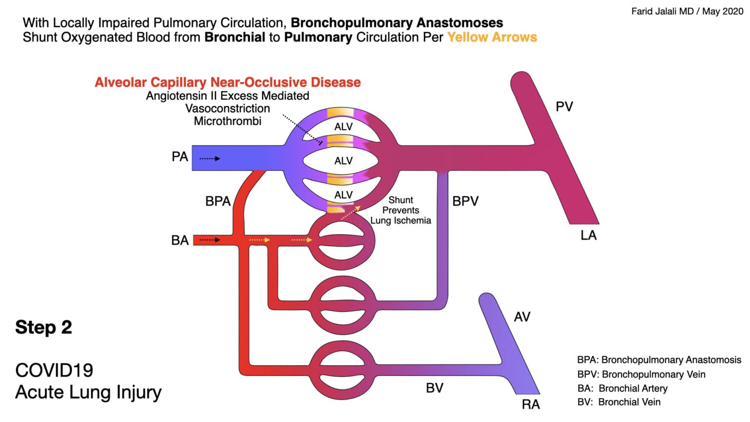 COVID-19 Acute Lung Injury: A Proposed Model (v1.0) via Farid Jalali ...