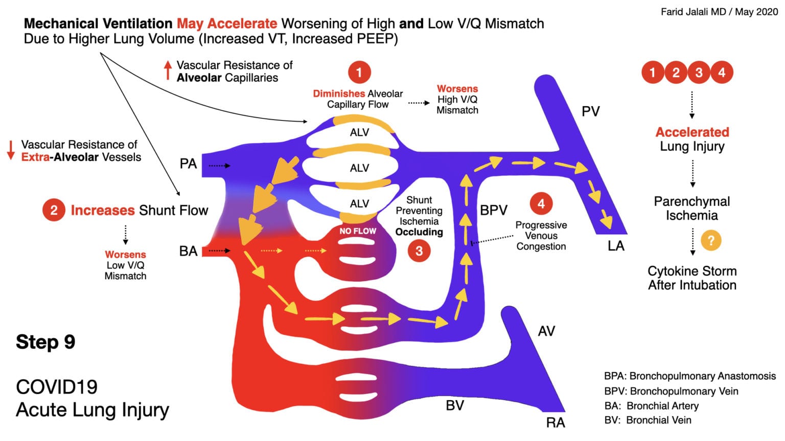 COVID-19 Acute Lung Injury: A Proposed Model (v1.0) via Farid Jalali ...