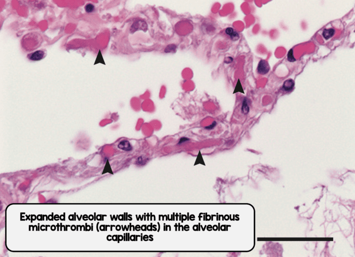 Microthrombi in Interalveolar Septa from COVID19 - REBEL EM - Emergency ...