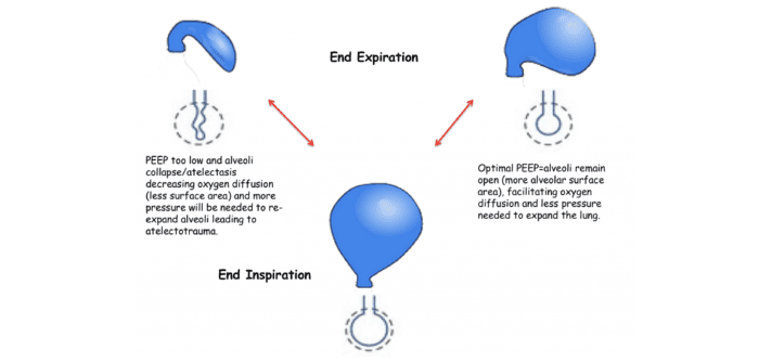 Optimal PEEP - REBEL EM - Emergency Medicine Blog