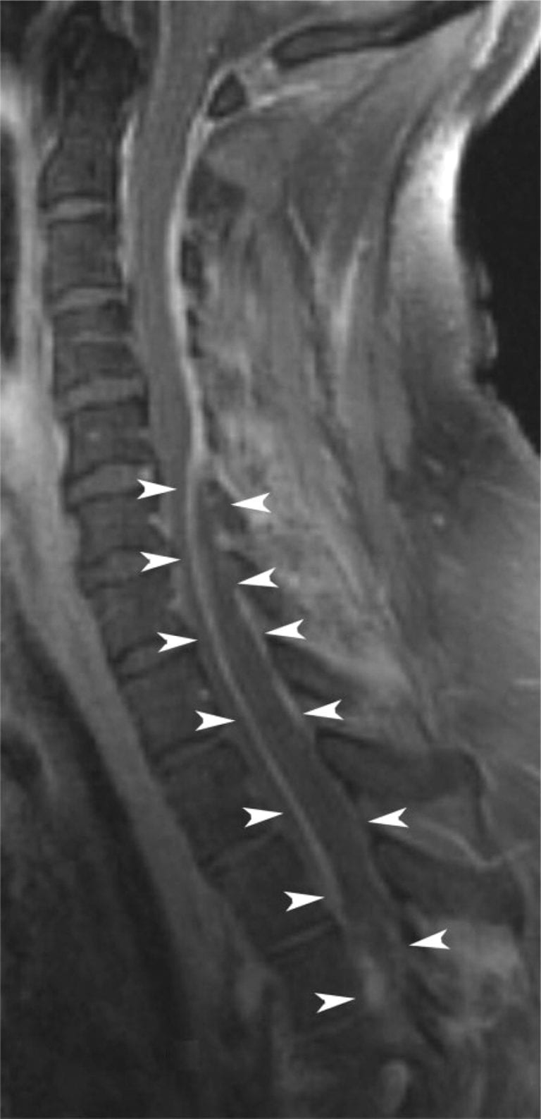 Spinal Epidural Abscess (SEA) - REBEL EM - Emergency Medicine Blog