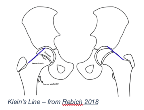 Slipped Capital Femoral Epiphysis (SCFE) - REBEL EM - Emergency ...