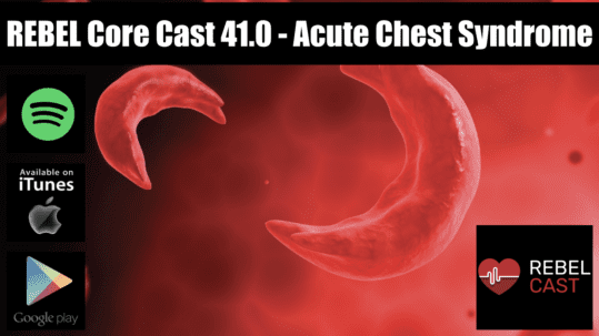 REBEL Core Cast 41.0 - Acute Chest Syndrome - REBEL EM - Emergency ...