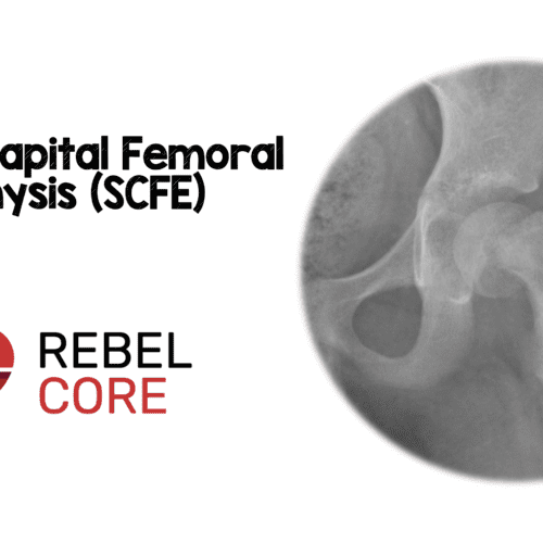 Slipped Capital Femoral Epiphysis (SCFE)