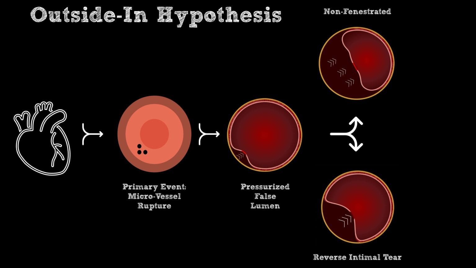 Spontaneous Coronary Artery Dissection (SCAD) - REBEL EM - Emergency ...
