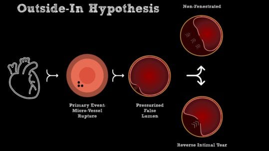 SCAD Outside In Hypothesis - REBEL EM - Emergency Medicine Blog