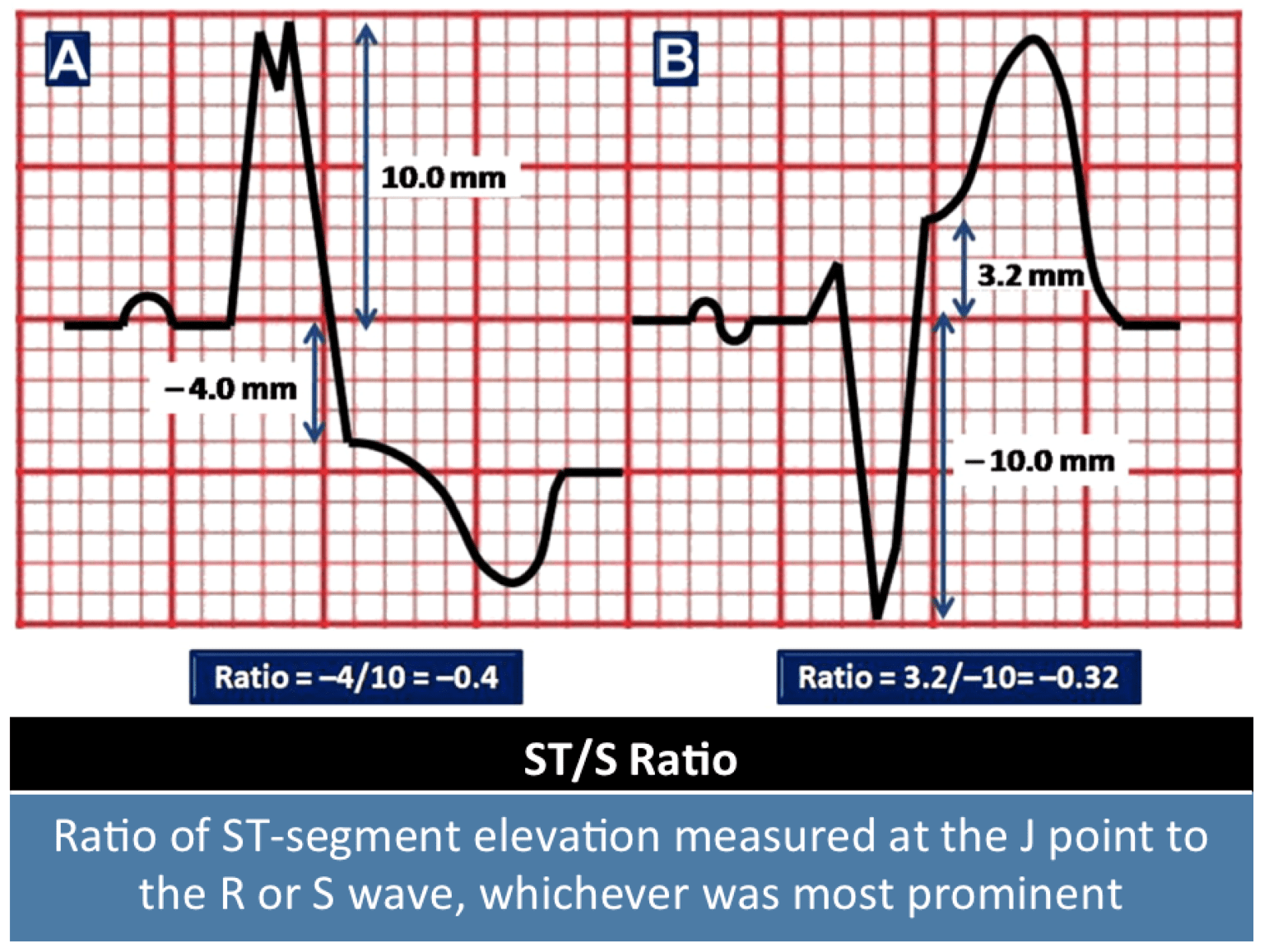 ST-S Ratio - REBEL EM - Emergency Medicine Blog