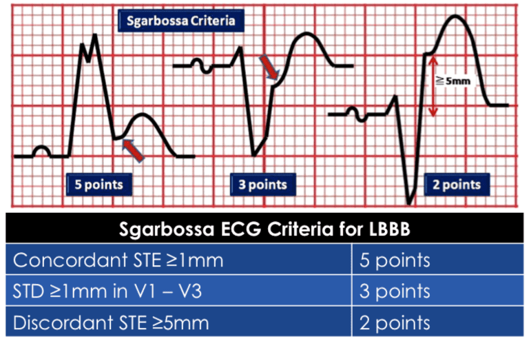 Sgarbossa Criteria - REBEL EM - Emergency Medicine Blog