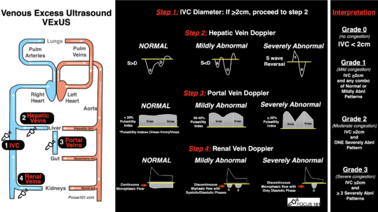 VExUS Score - REBEL EM - Emergency Medicine Blog