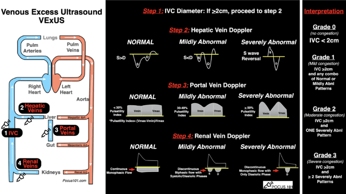 VExUS Score - REBEL EM - Emergency Medicine Blog