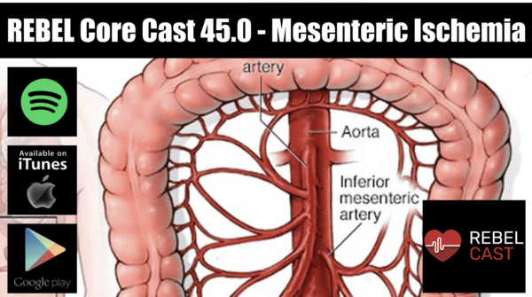 REBEL Core Cast 45.0 - Mesenteric Ischemia - REBEL EM - Emergency ...