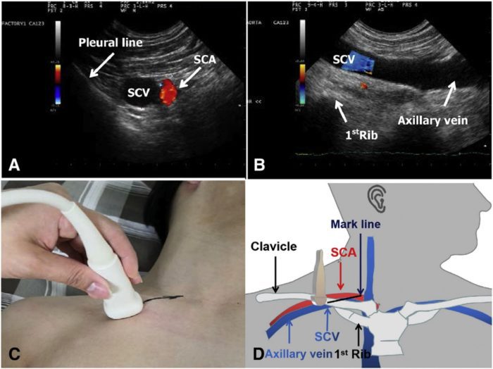US for CVC Figure 1 - REBEL EM - Emergency Medicine Blog