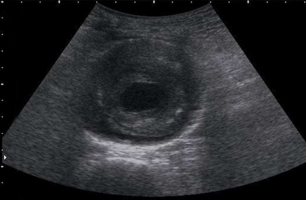 REBEL Core Cast 49.0 - Abdominal Aortic Aneurysm (AAA) - REBEL EM ...