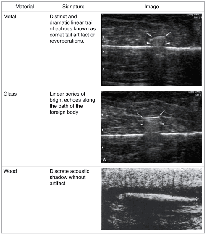 POCUS and Soft Tissue Foreign Bodies - REBEL EM - Emergency Medicine Blog