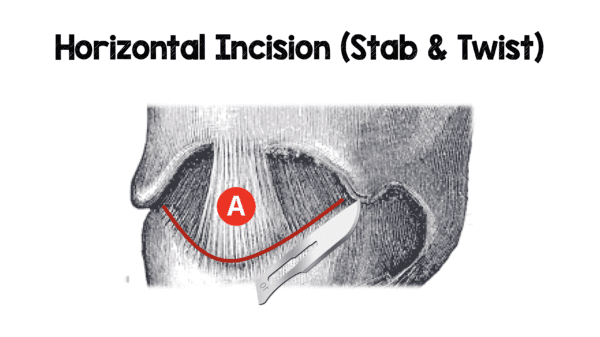 Horizontal Incision - REBEL EM - Emergency Medicine Blog