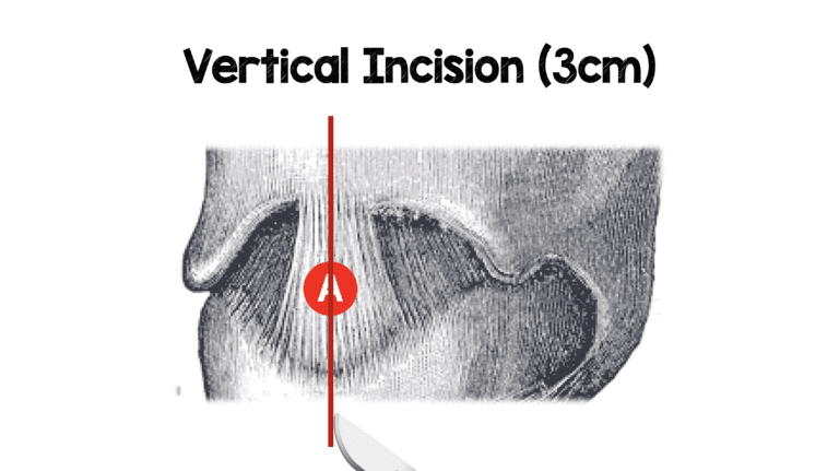 Vertical Incision - REBEL EM - Emergency Medicine Blog