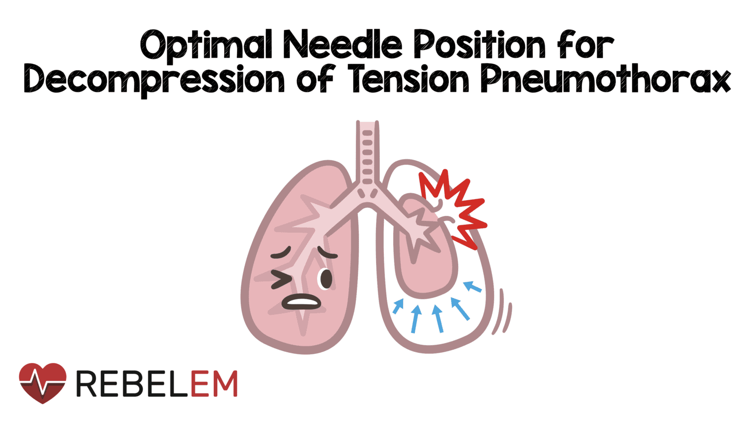 Optimal Needle Position for Decompression of Tension Pneumothorax ...