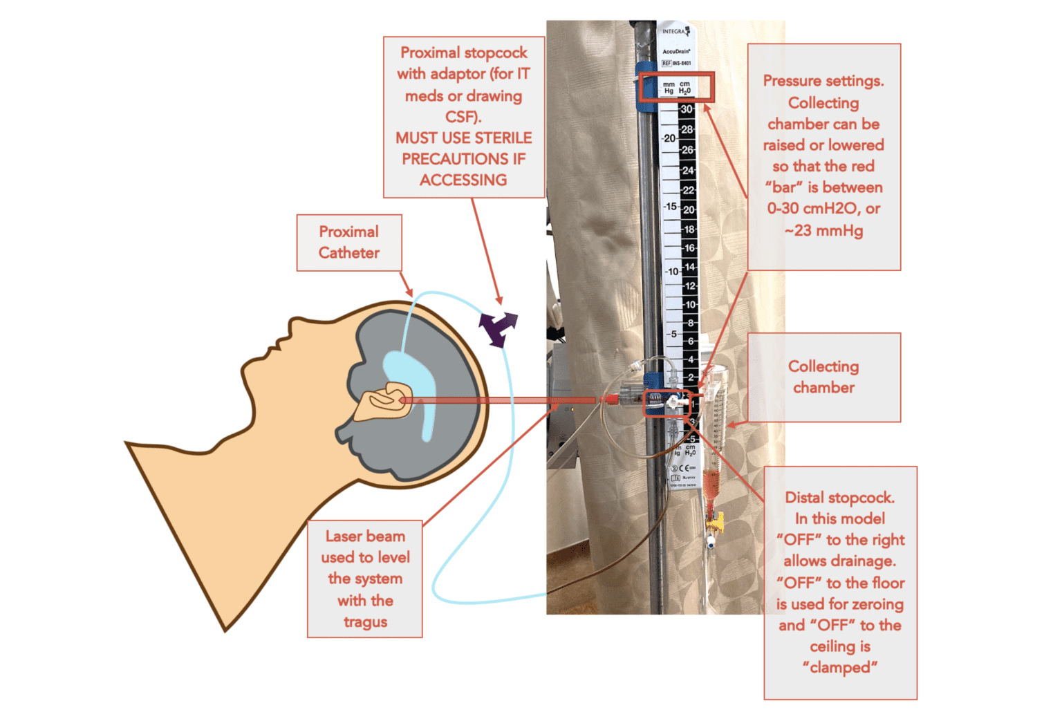 EMCrit EVD Drain Setup - REBEL EM - Emergency Medicine Blog