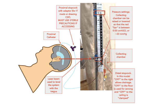 EMCrit EVD Drain Setup - REBEL EM - Emergency Medicine Blog