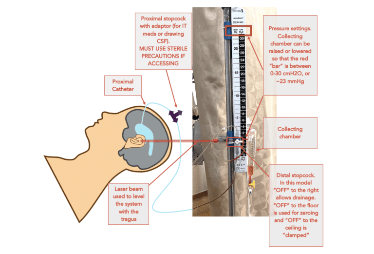 EMCrit EVD Drain Setup - REBEL EM - Emergency Medicine Blog