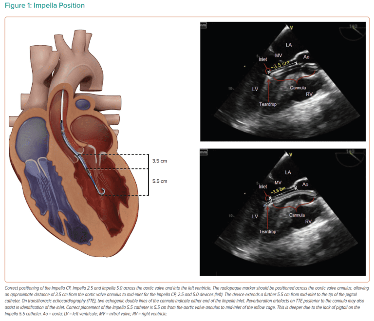 Impella Devices 101 - REBEL EM - Emergency Medicine Blog