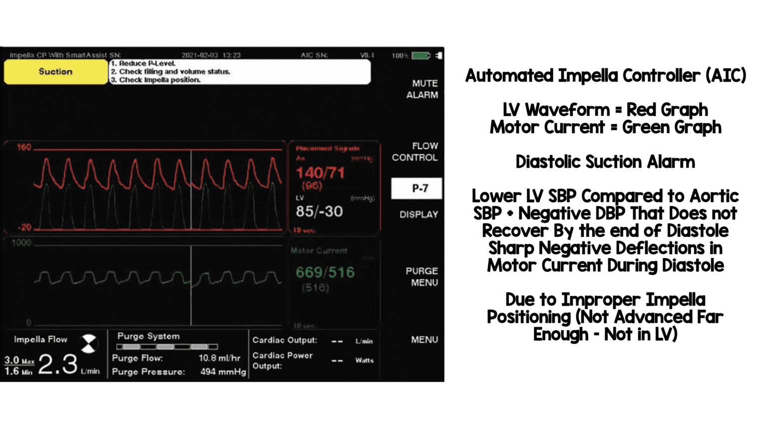 Impella Devices 101 - REBEL EM - Emergency Medicine Blog