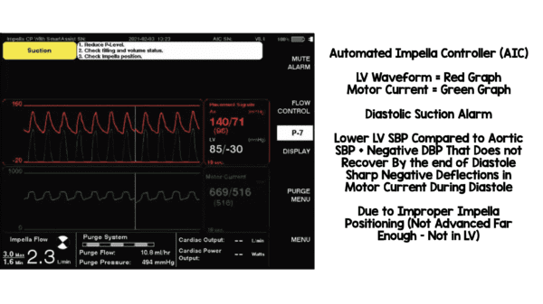 Impella Devices 101 - REBEL EM - Emergency Medicine Blog