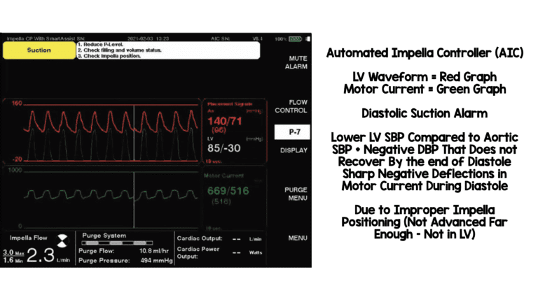 Impella Devices 101 - REBEL EM - Emergency Medicine Blog