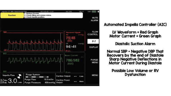 Impella Devices 101 - REBEL EM - Emergency Medicine Blog