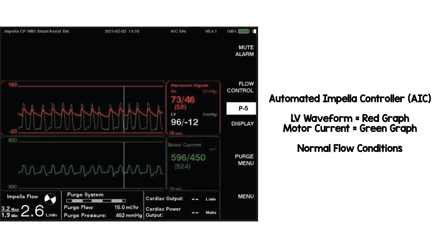 Impella Devices 101 - REBEL EM - Emergency Medicine Blog