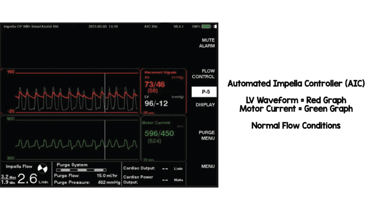 Impella Devices 101 - REBEL EM - Emergency Medicine Blog