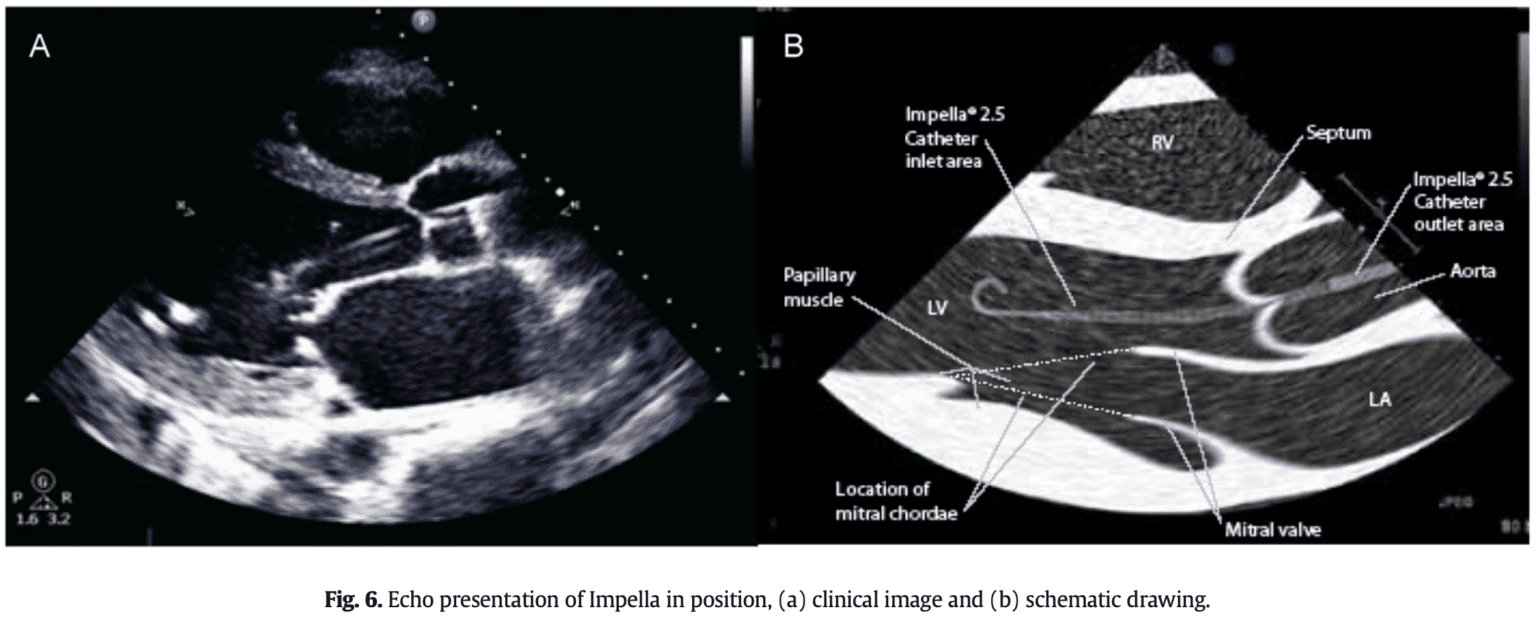 Impella Devices 101 - REBEL EM - Emergency Medicine Blog