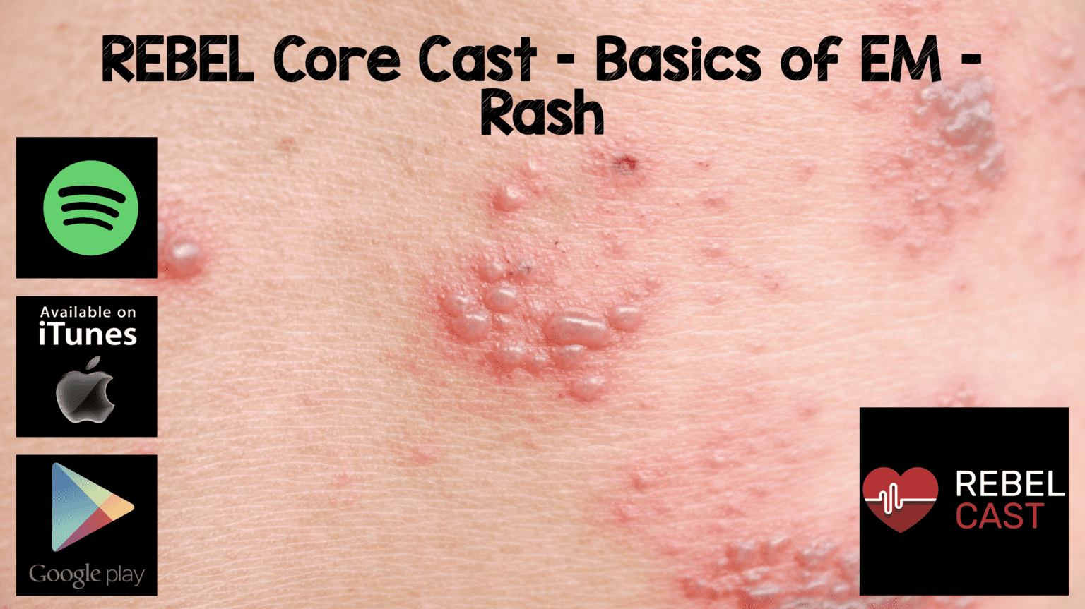 REBEL Core Cast - Basics of EM - Rash - REBEL EM - Emergency Medicine Blog
