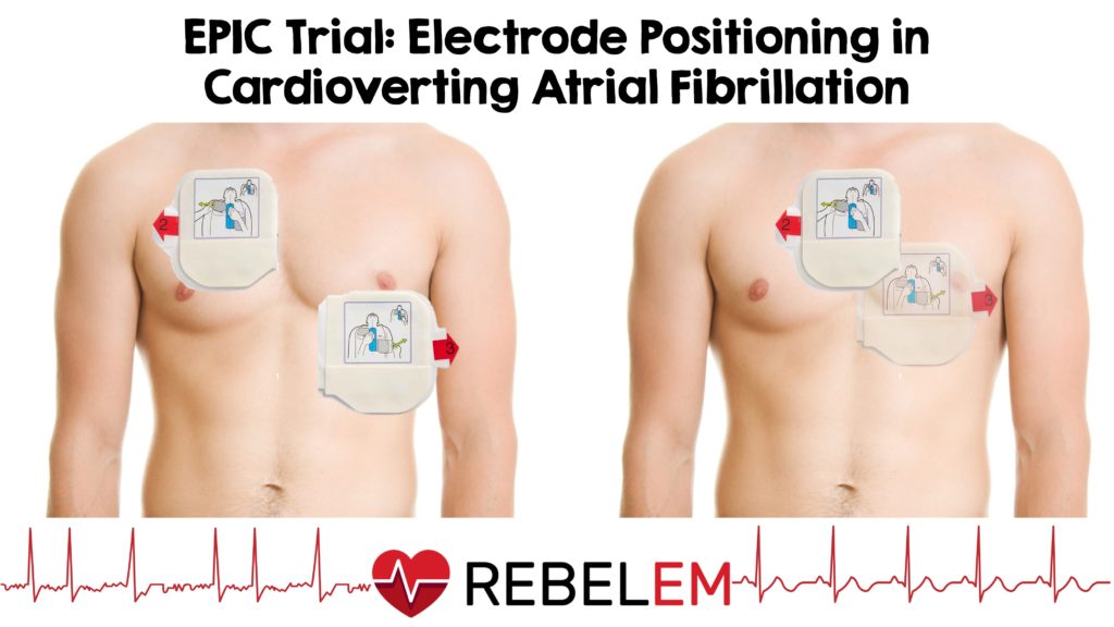 Defibrillation Archives REBEL EM Emergency Medicine Blog