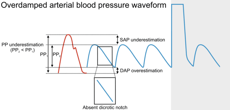 Damping and Arterial Lines - REBEL EM - Emergency Medicine Blog