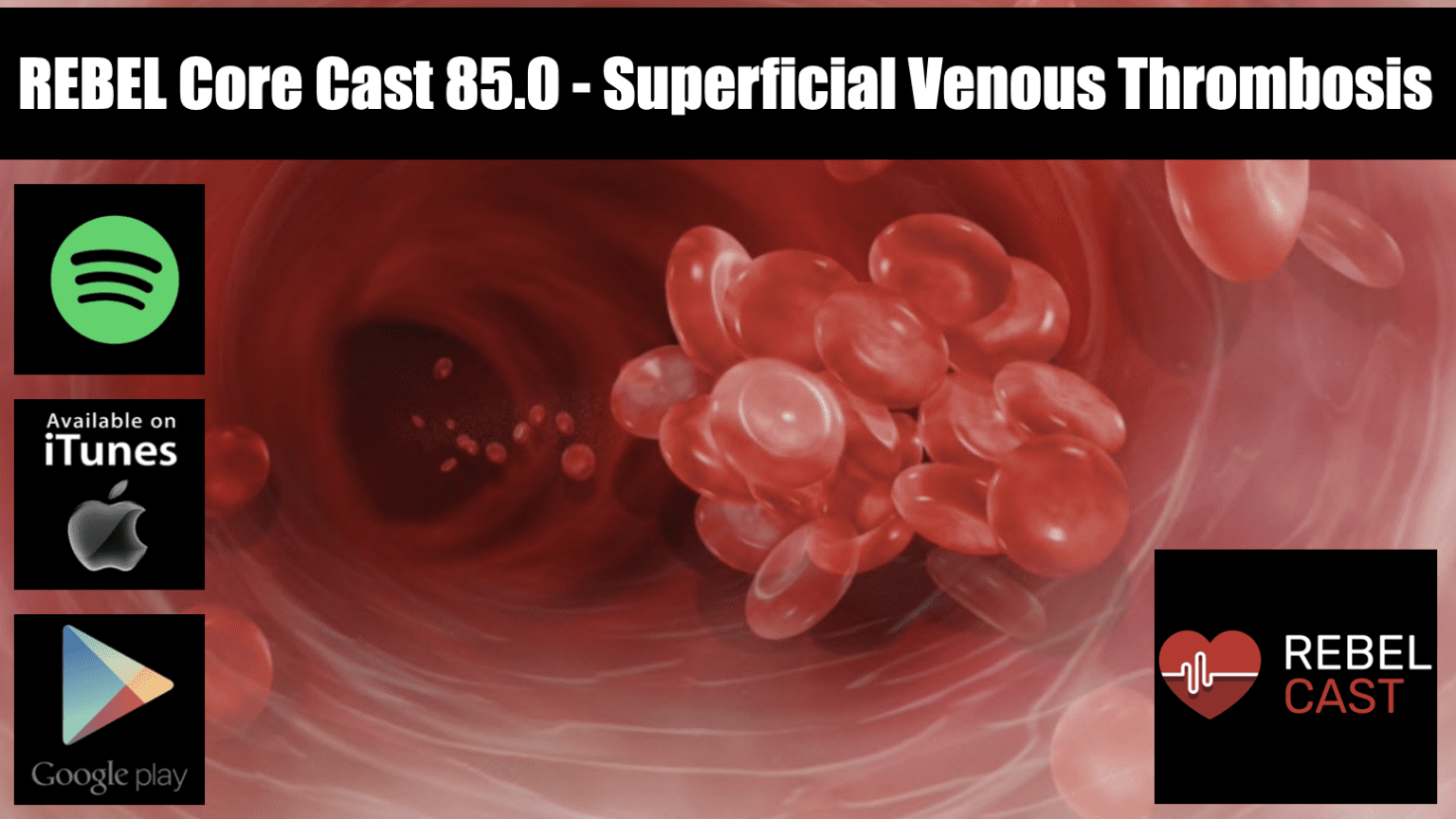 REBEL Core Cast 85.0 - Superficial Venous Thrombosis - REBEL EM ...