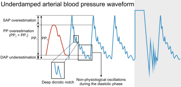 Damping and Arterial Lines - REBEL EM - Emergency Medicine Blog
